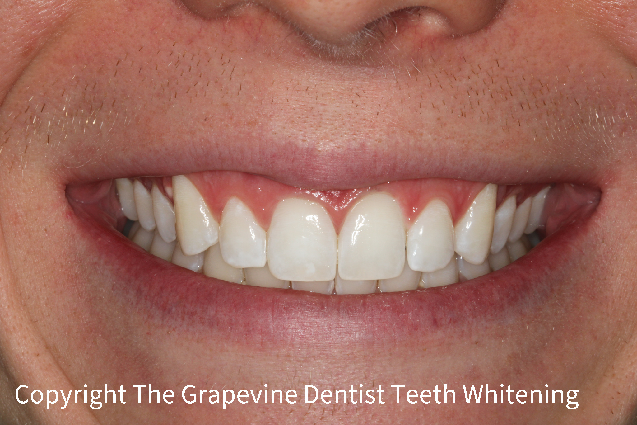 Teeth Whitening - Grapevine Texas